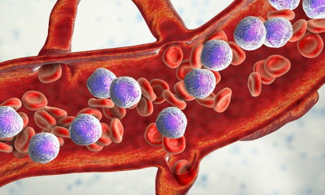 มะเร็งเม็ดเลือดขาวกลุ่มลิมโฟซิติค (Acute Lymphocytic Leukemia)